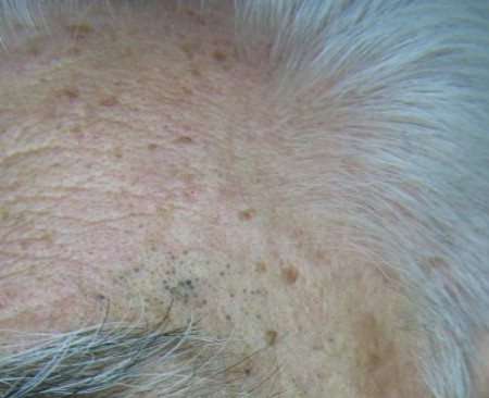 Αποτελέσματα – Δερματολόγος / Αφροδισιολόγος | Εφαρμογές Laser